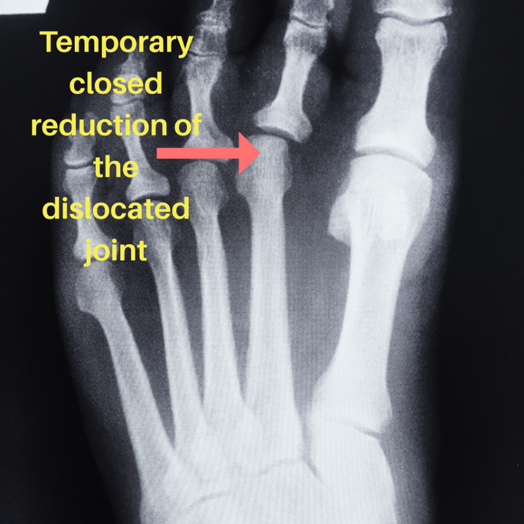 Plantar Plate Injury | Final Kick Ankle and Foot Clinic Ankle and Foot ... Plantar Plate Injury | Final Kick Ankle and Foot Clinic Ankle and Foot ...